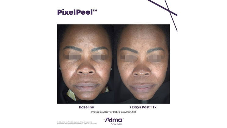 Alma Introduces PixelPeel™ Laser Peel for Minimal-Downtime Skin Renewal ...