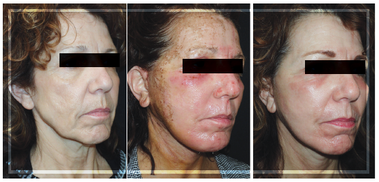 The CO2RE®: The Right Choice for Full-Face Resurfacing