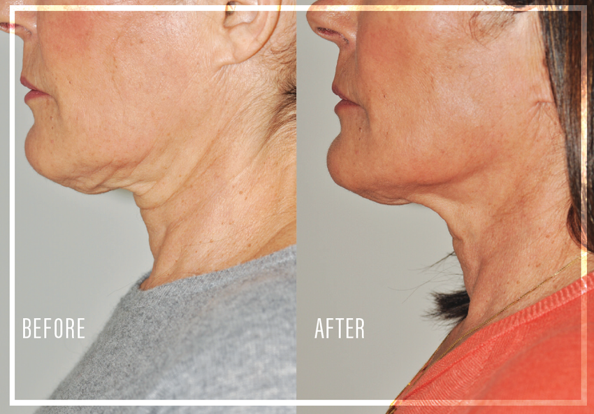 Thermitight: Precise Subcutaneous RF for Optimal Tissu...