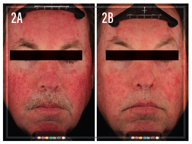 The Versatile Vbeam® Prima: A New Generation Offers Ev...