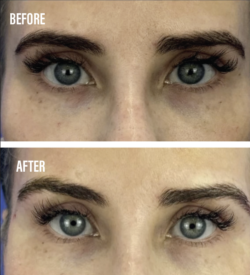 Combining Thread Lifting and Filler Injections