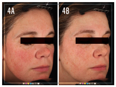 The Versatile Vbeam® Prima: A New Generation Offers Ev...