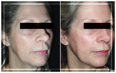 The CO2RE®: The Right Choice for Full-Face Resurfacing