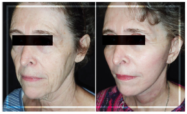 The CO2RE®: The Right Choice for Full-Face Resurfacing