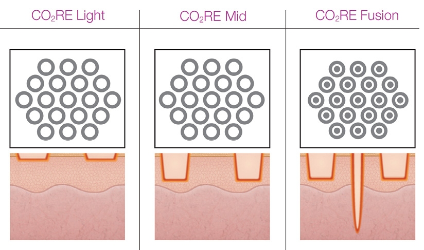 The CO2RE®: The Right Choice for Full-Face Resurfacing