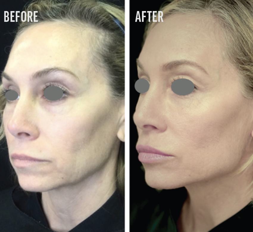 A Masterclass in Microneedling: Powerful Tools for Cus...