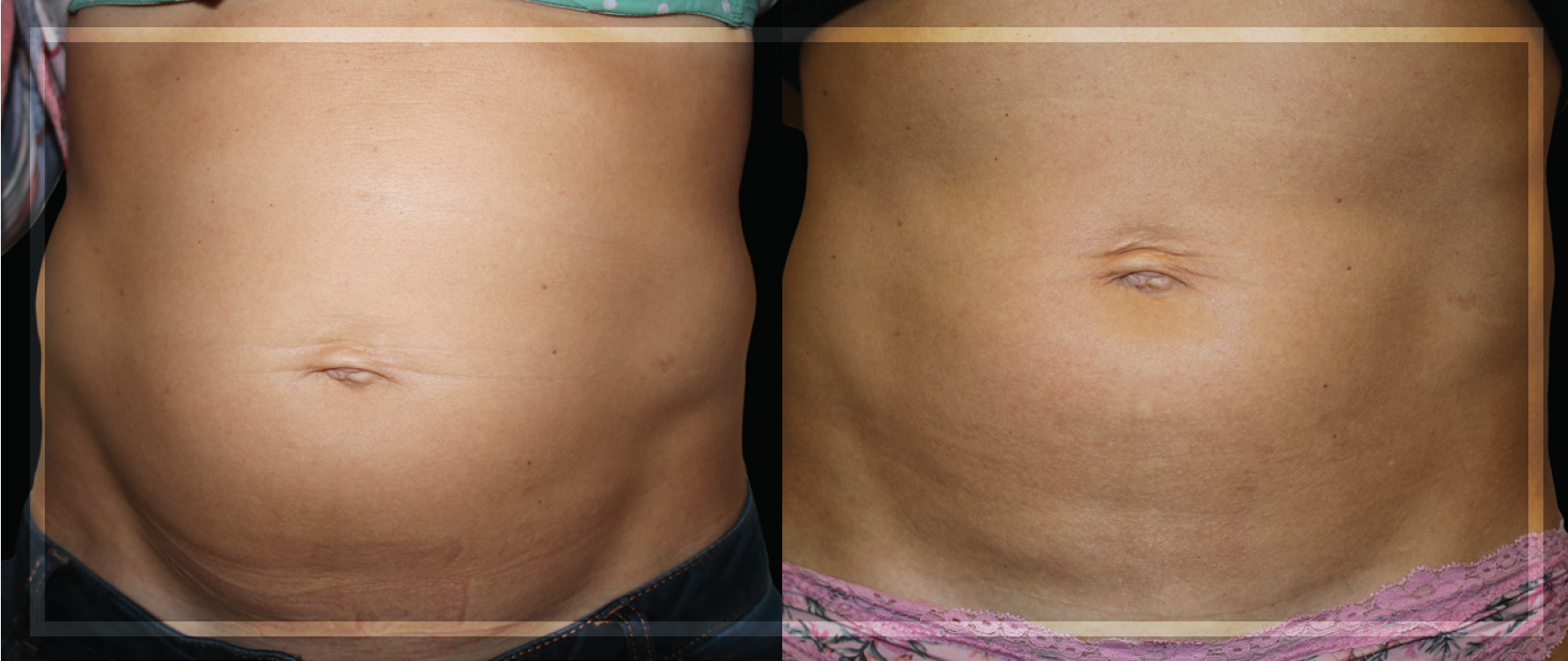 A Fitness First: Emsculpt Builds Muscle and Reduces Fa...