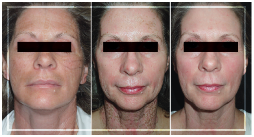 The CO2RE®: The Right Choice for Full-Face Resurfacing