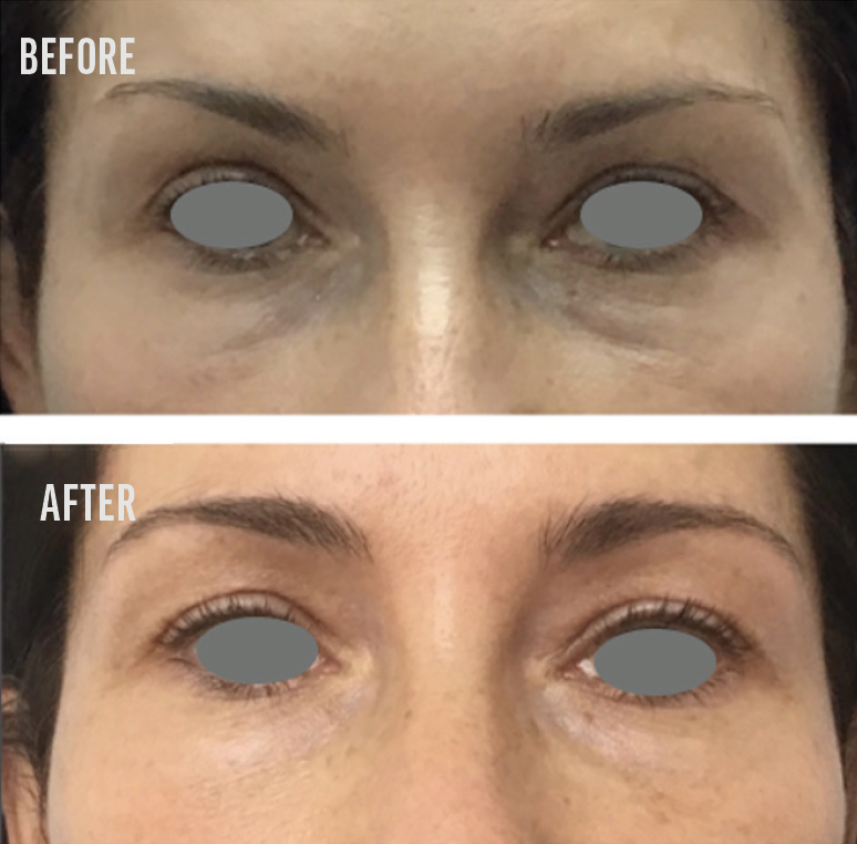 A Masterclass in Microneedling: Powerful Tools for Cus...