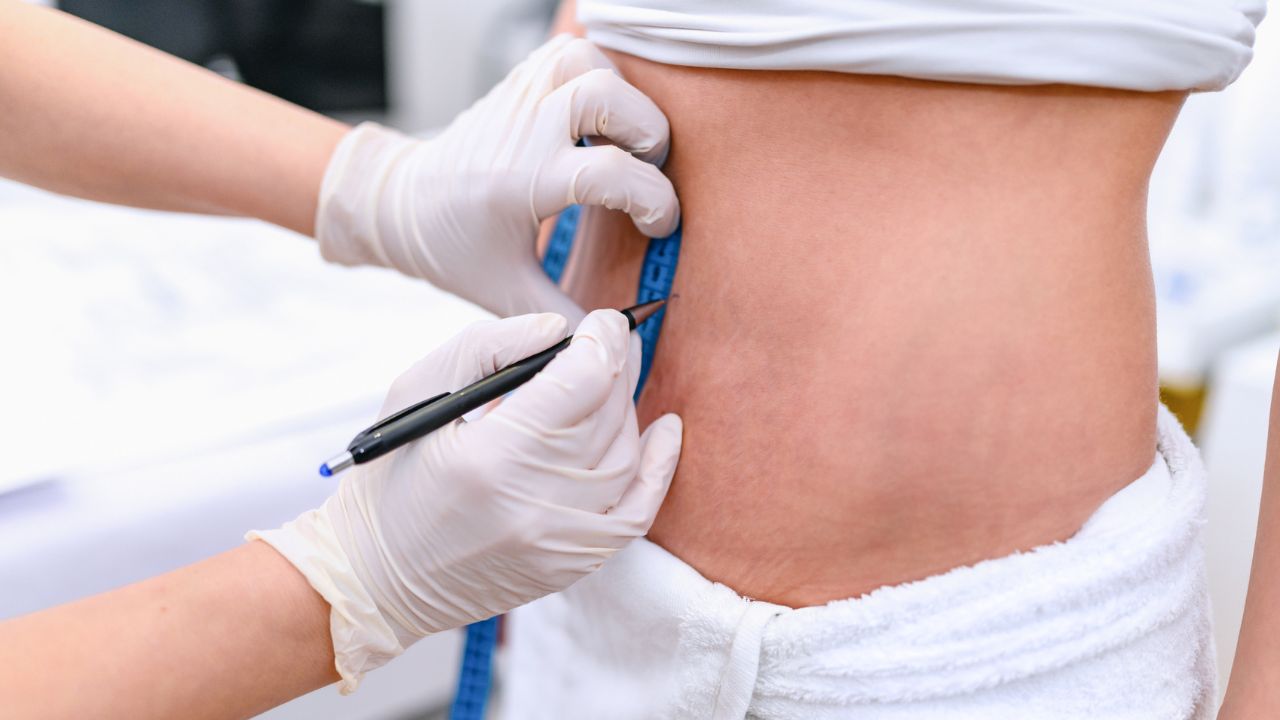 Topical Carboxytherapy for Latrogenic Skin Burns Follo...